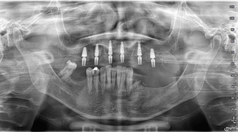 Full arch solutions - Open Dental Community